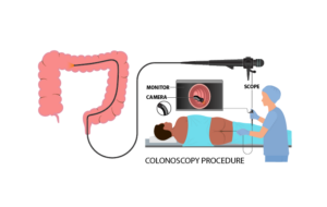 Getting A Colonoscopy? | Bowel Prep Instructions | Grady Health